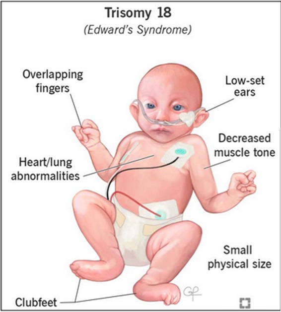 Edwards syndrome identified for the first time in prehistoric remains ...