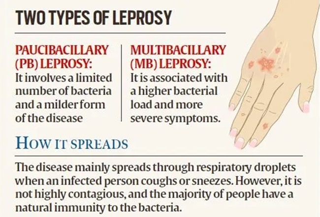 A new treatment system for leprosy - Sanskriti IAS
