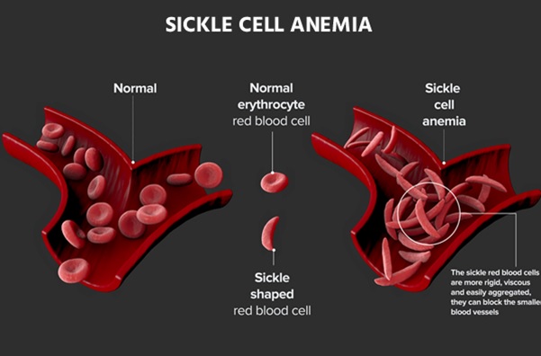 National mission to eradicate sickle cell anemia - Sanskriti IAS