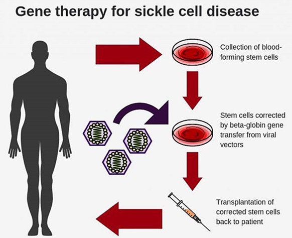 Gene therapy treatment for sickle cell - Sanskriti IAS